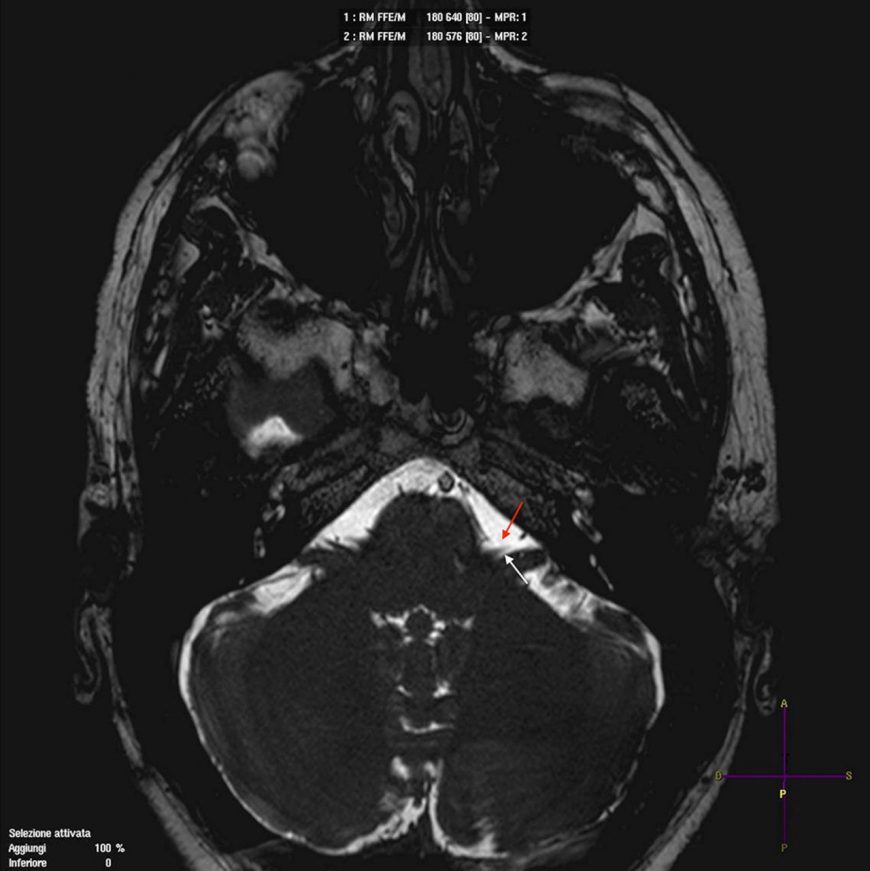 Hemifacial Spasm | Parkinsons Disease and Movement Disorders Clinic