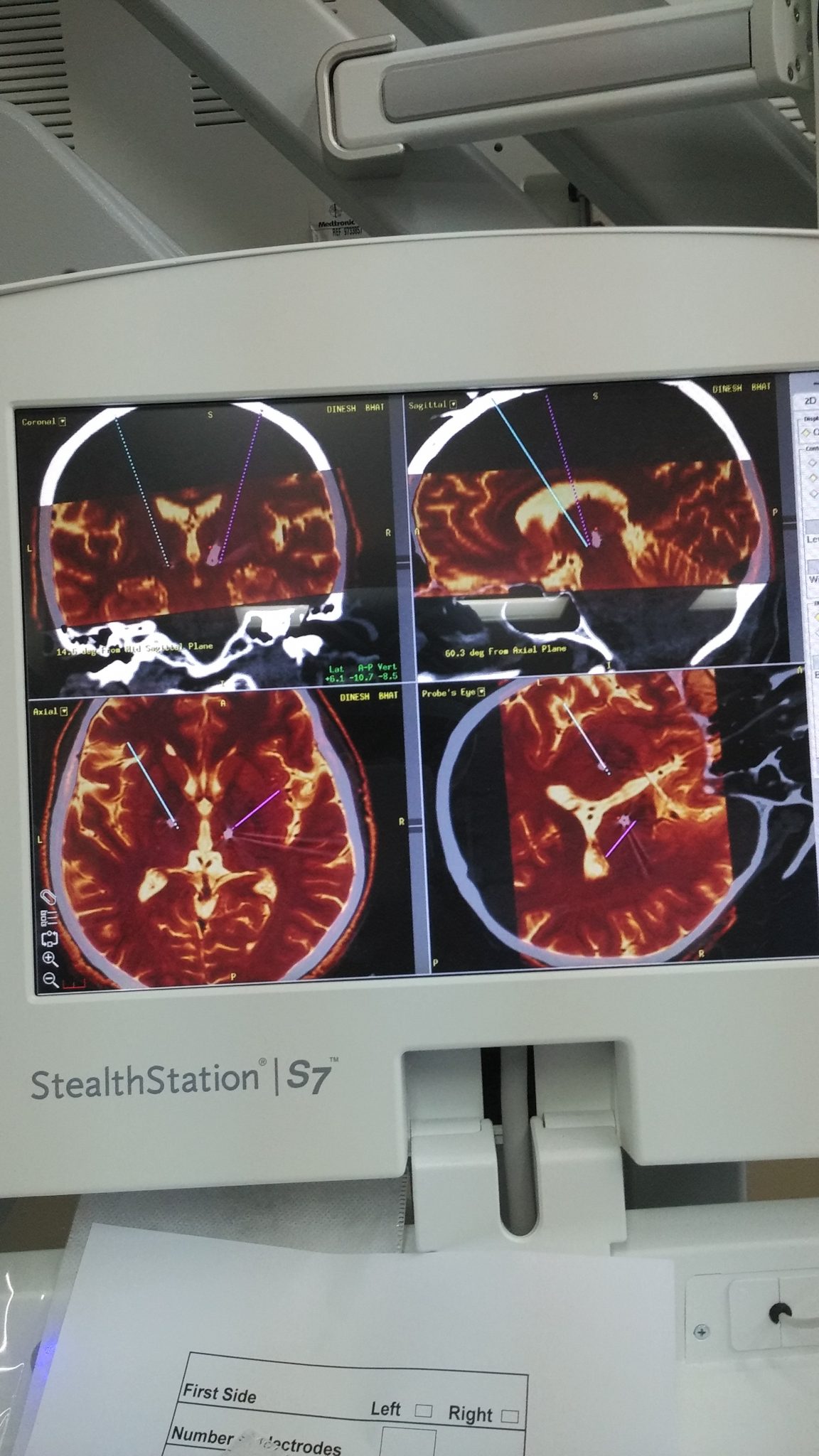 Understanding the Process of Deep Brain Stimulation (DBS) Surgery ...